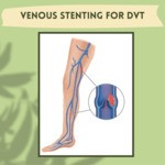 Venous Stenting For DVT, Stent Implantation, Thrombosis Management ...