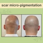 Scar Micro-Pigmentation, Scalp Micropigmentation, Scalp Tattooing ...