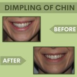 Dimpling On The Chin, Artificial Dimple, Botox Filler Treatment Surat ...
